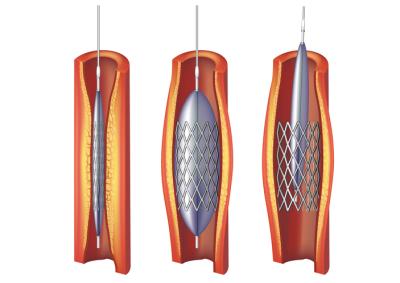 What Is Coronary Angioplasty? | Catholic Health