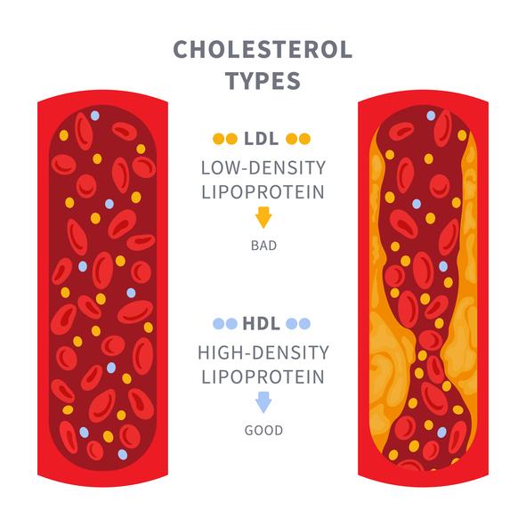 Good vs. Bad Cholesterol: What’s the Difference? | Catholic Health Long ...